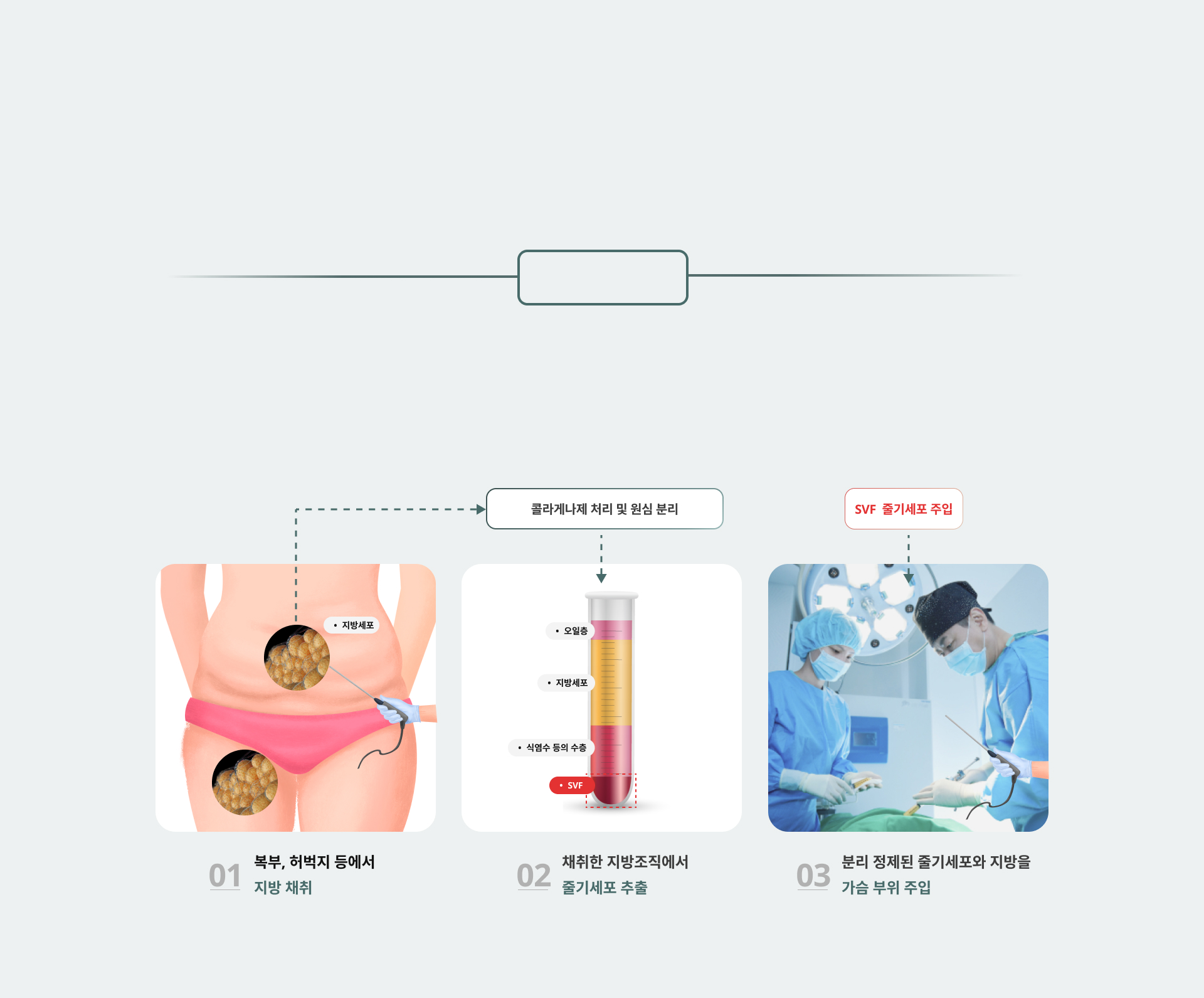 SC301의원 줄기세포 가슴수술 전문센터